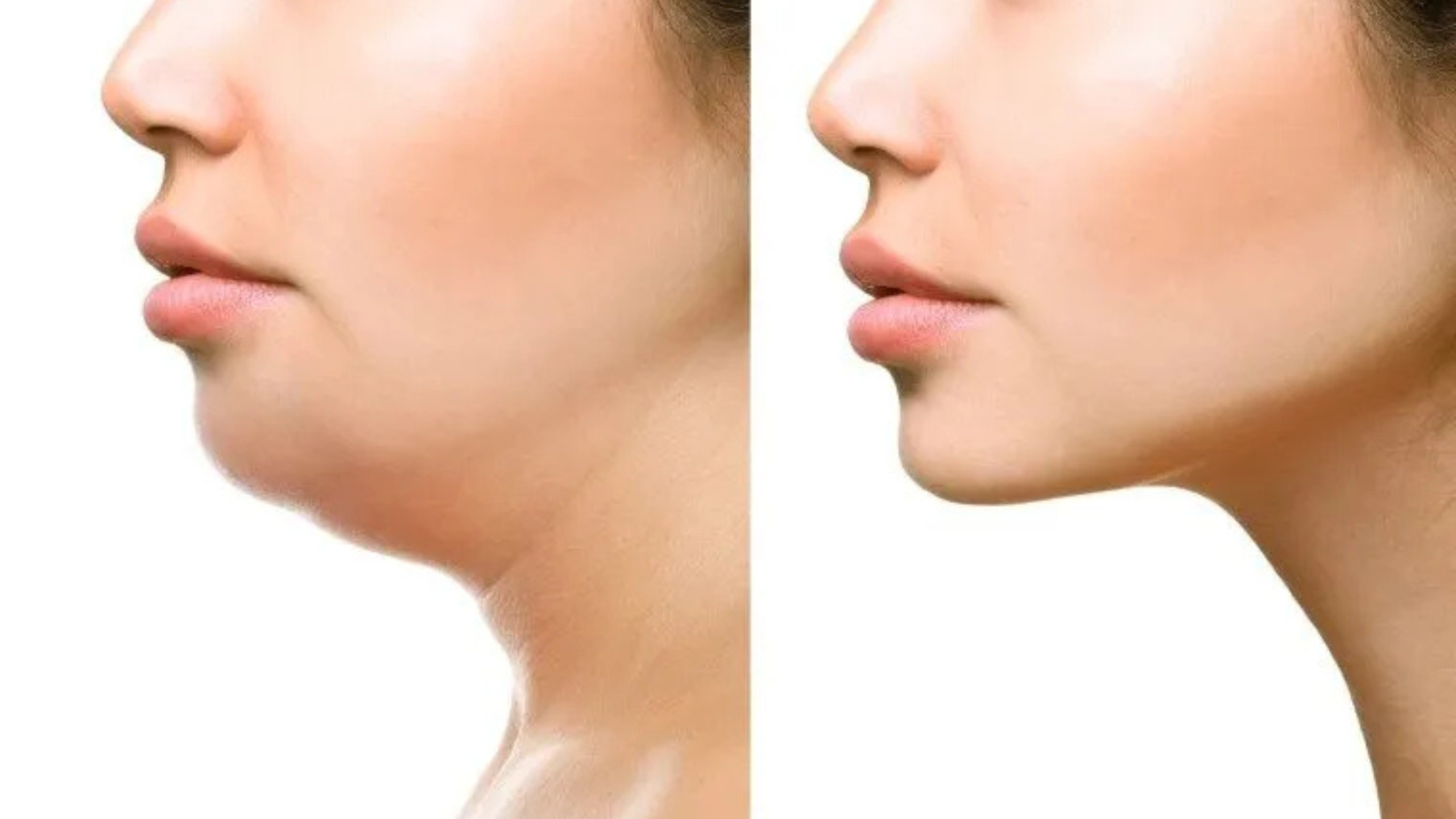 Double Chin or Skin Laxity? How to Tell the Difference and Why It Matters